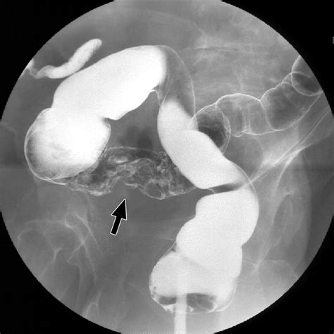 Angiodysplasia Mimicking Colon Cancer Colonoscopy Double Contrast Barium Enema And Ct