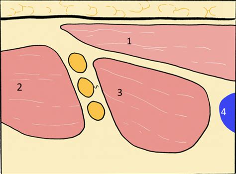 Interscalene Nerve Block Anatomy Graphic Sonosite Institute For