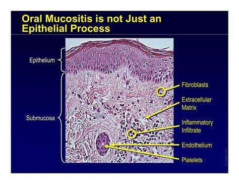 Oral Mucositis