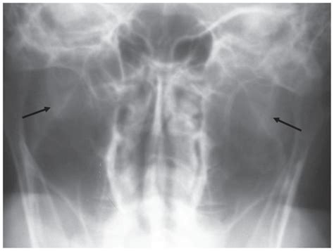 Towne Radiograph Shows Bilateral Elongated Styloid Processes Right 29 Download Scientific