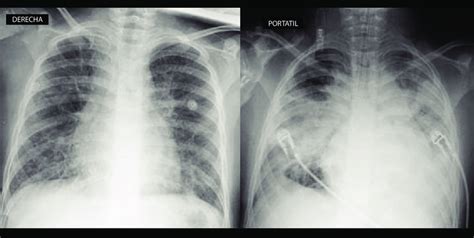 Chest X Rays Left On Admission With Interstitial Infiltrates And Download Scientific Diagram