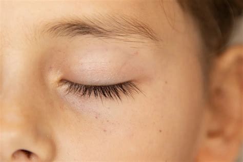 Petechiae In The Eyes Signs Causes And Treatments Pair Eyewear
