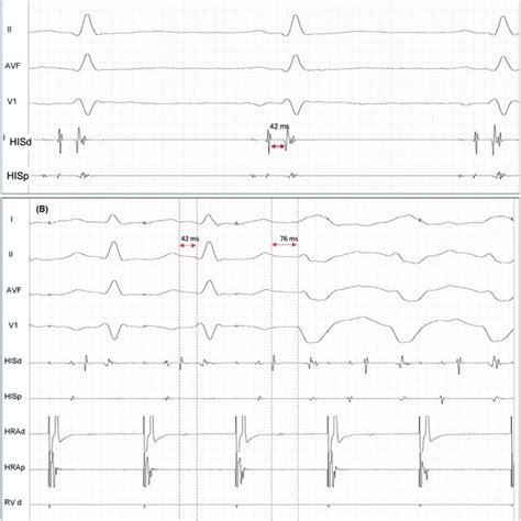 A Ecg On The Day Of The Episode Showing Complete Lbbb B Subsequent Download Scientific