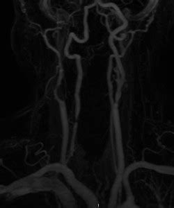 Vertebral Artery Stenosis Symptoms Diagnosis And Treatment