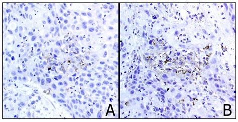 Case No 24 Overestimation Of The Staining In Punctate Necrosis Areas