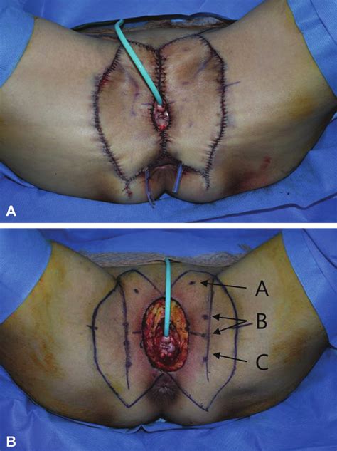 Case 2 Double Opposing Keystone Flap A After Radical Wide Excision