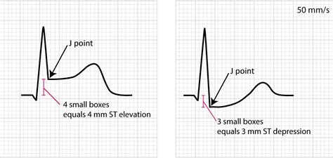 Pin Auf Ekg
