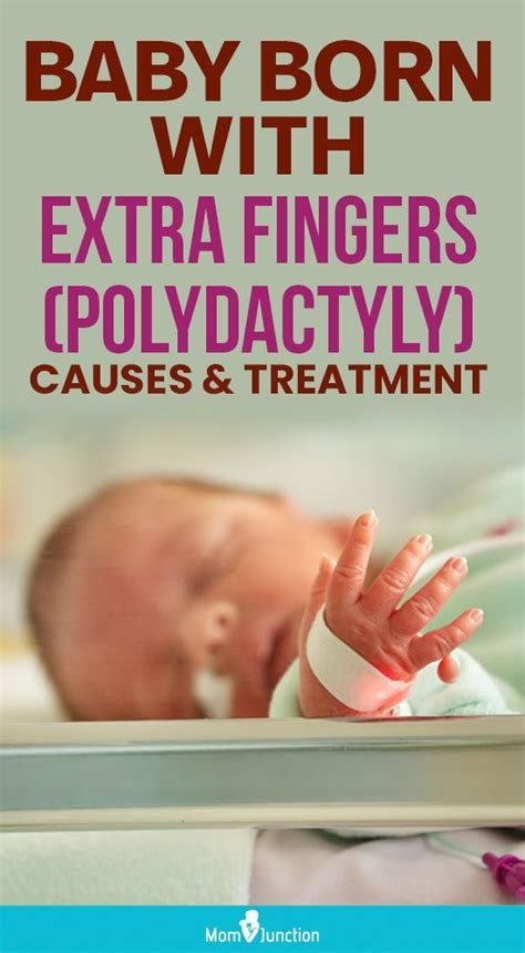 Polydactyly Extra Fingers In Babies Causes And Treatment Artofit