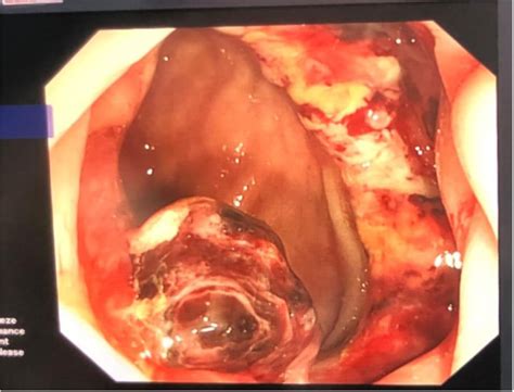 Caecal Circumscribed Ulceration With Central Small Polypoid Lesion No