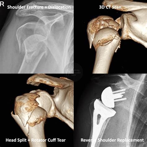 Shoulder Dislocation Surgery Screw At Emma Wilhelm Blog