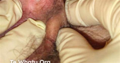 Vulval Cyst 0006 Image