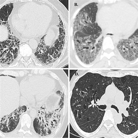Patterns Of Interstitial Lung Disease On High Resolution Computerized