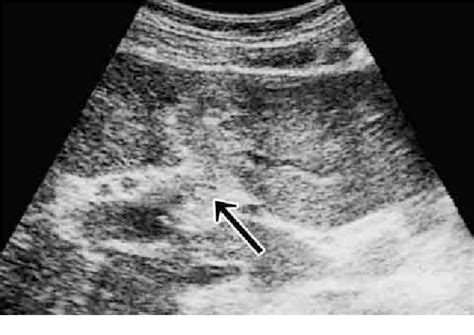 Figure 1 From A Patient With Adult Extrahepatic Portal Obstruction Of Which Distinction From