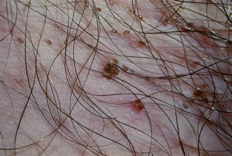 Skin Infections Pictures Types Causes And Treatment