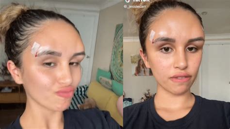 Modelo Fica Com Testa Inchada Após Procedimento Foxy Eyes Dar Errado