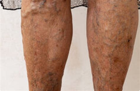 Peripheral Artery Disease Pad Advanced Medical Group