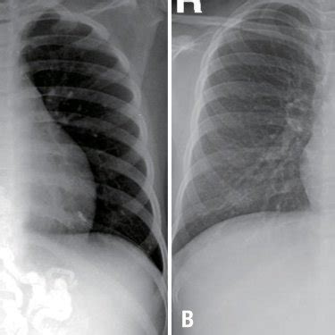 On Esophagogastroduodenostopy A Grade Iii Varices With Red Wale Sign Download Scientific