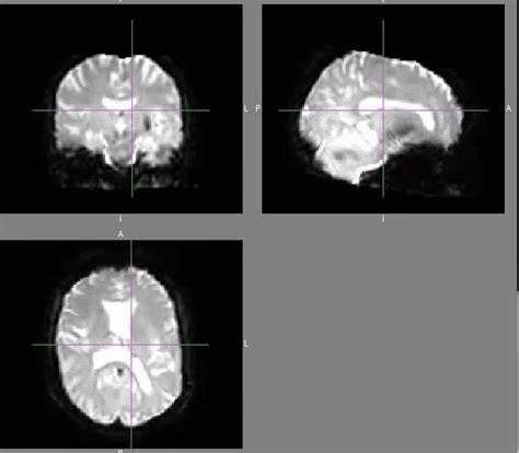Fmriprep Distortion Correction Issue Hyperintensity In Cerebellum