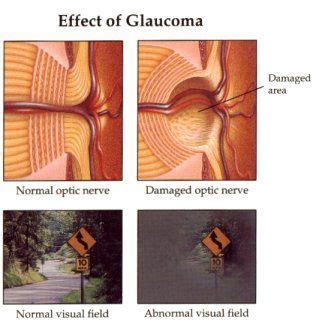 Glaucoma Optic Nerve Damage Glaucoma Treatment Trabeculectomy Surgery