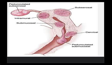 Fibromyoma Uterus By Dr Hk Cheema Pdf Pregnancy Reproductive Health