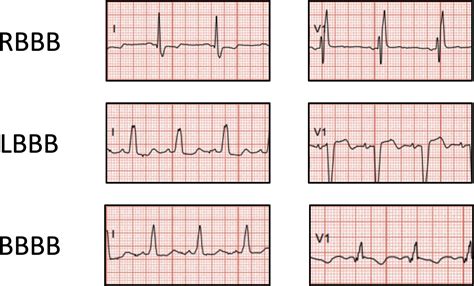 Bilateral Bundle Branch Block Cardiology Clinics