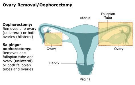Recovery Time After Laparoscopic Surgery For Ovarian Cyst Gsdq