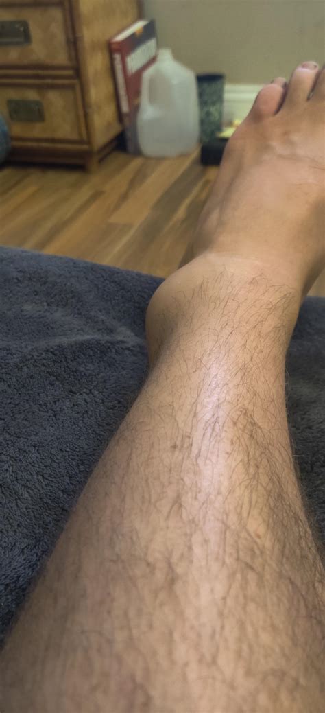 Torn Tendon Album On Imgur