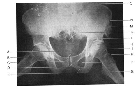 Anteroposterior Oblique Pelvis Projection Modified Cleaves Method