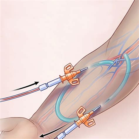 Creating Av Fistula For Dialysis