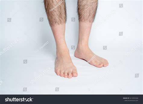Legs Hair Removal Men Before After Stock Photo Shutterstock