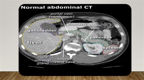 Radiological Anatomy Of Biliary System Pptx