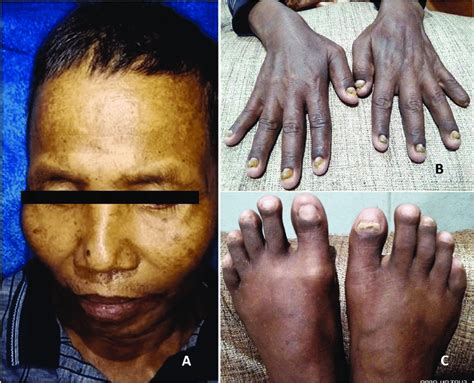 Physical Examination Findings Of Ccs Show A Hyperpigmentation Of The