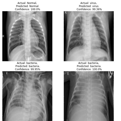 Chest X Ray Images Pneumonia With New Class Kaggle