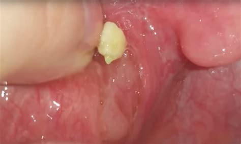 What Causes Tonsil Stones If You Still Have Tonsils You Basically Cant Avoid Getting Them