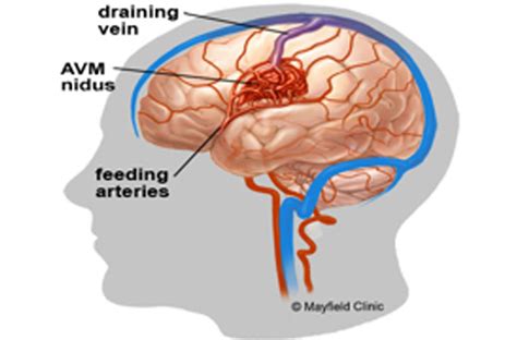 Ateriovenous Malformation Congenital Avm