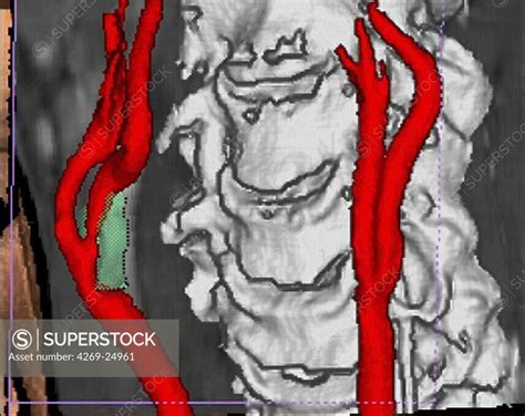 Stenosis Of Carotid Artery 3d Computed Tomographic Ct Scan