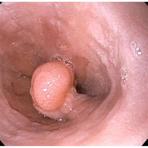 Polyp Located In Distal Esophagus Near Gastroesophageal Junction Prior