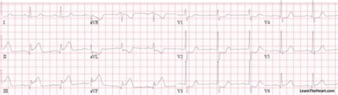 Ekg Quiz 3 Stemi Flashcards Quizlet