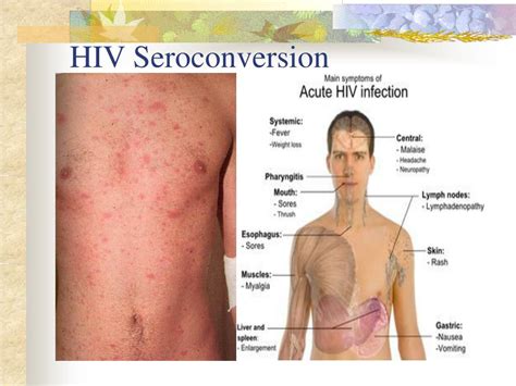 Ppt Hiv And Aids Powerpoint Presentation Free Download Id6104997