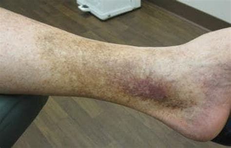 Stasis Dermatitis Medizzy