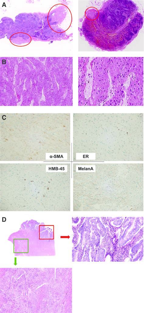 A The Maximum Size Lymph Node Was Dissected From The Left Lateral Download Scientific Diagram