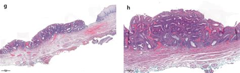 Barretts Esophagus With Low Grade Dysplasia Springerlink