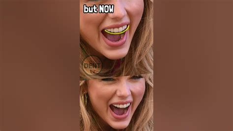 Taylor Swift Before And After Veneers