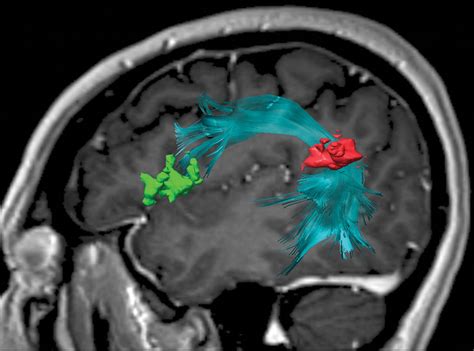 Inferior Frontal Gyrus Mri