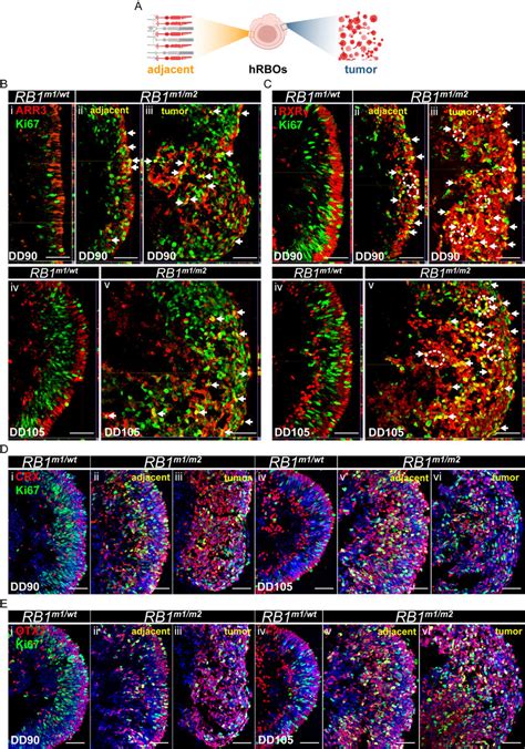 Rb Tumor And Adjacent Tissues Highly Express Cone And Cone Precursor