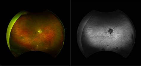 Posterior Uveitis