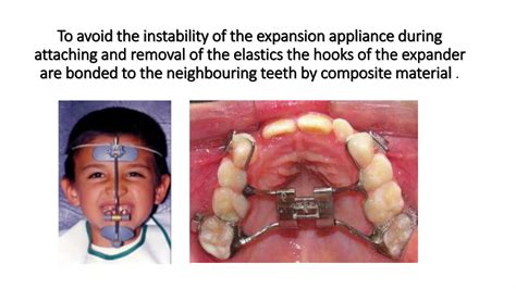 Orthopedic Protraction Of The Maxilla Part 1 Pptx