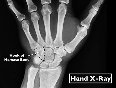 Hamate Fracture X Ray At Rodney Murphy Blog