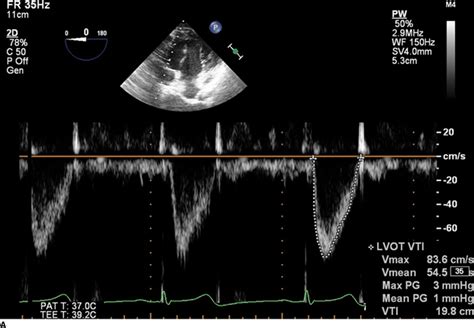 Normal Aortic Valve Echo