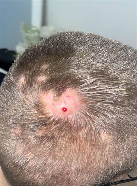 Folliculitis Decalvans Rfolliculitis